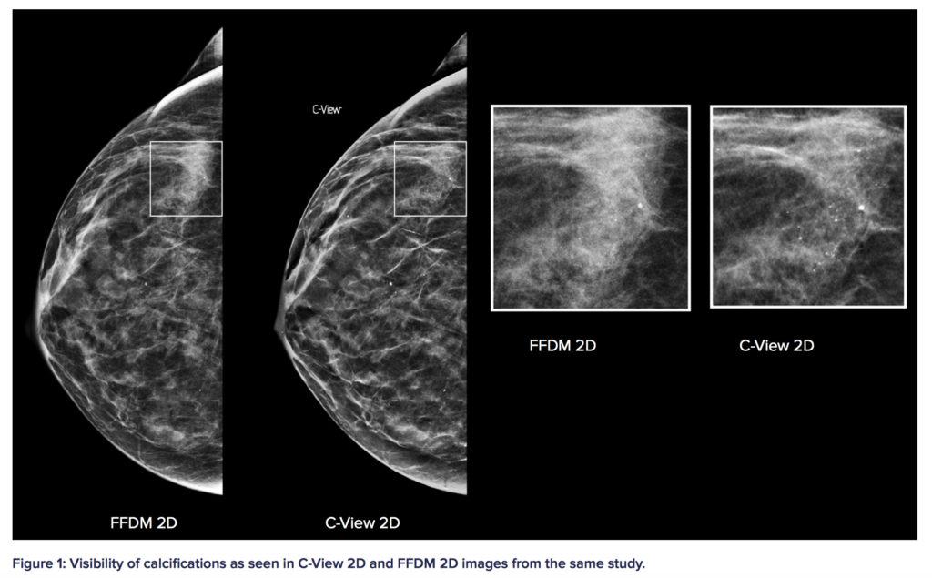 Microcalcification in C view - Breast Cancer HK 香港的乳癌治療資訊